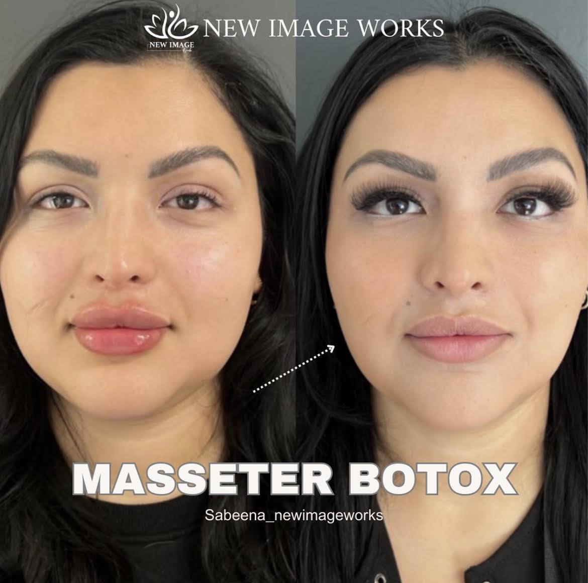 Masseter Botox – New Image Works